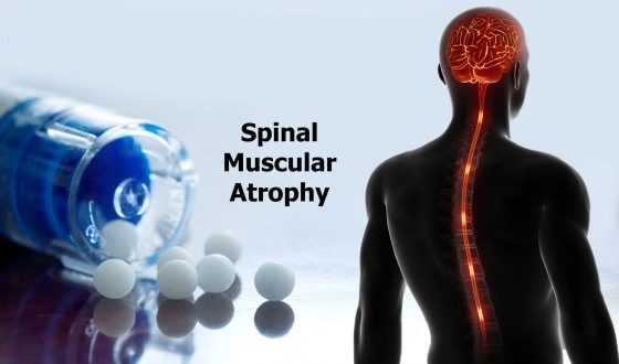 Spinal Muscular Atrophy – Types, Diagnosis, and Treatment.