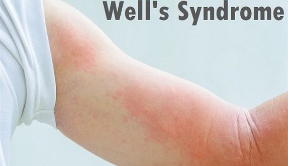 Wells Syndrome or Eosinophilic Cellulitis – Overview and Causes