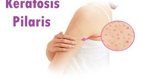 Keratosis Pilaris (KP) – Pathophysiology, Types and Treatment