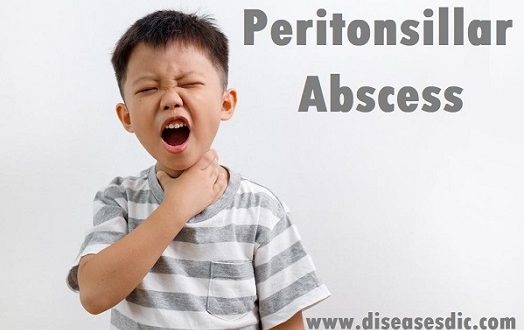 Peritonsillar Abscess – Pathophysiology, Causes and Prevention
