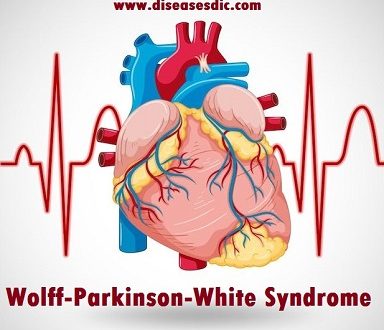 Wolff-Parkinson-White Syndrome (WPW) – Types, and Treatment