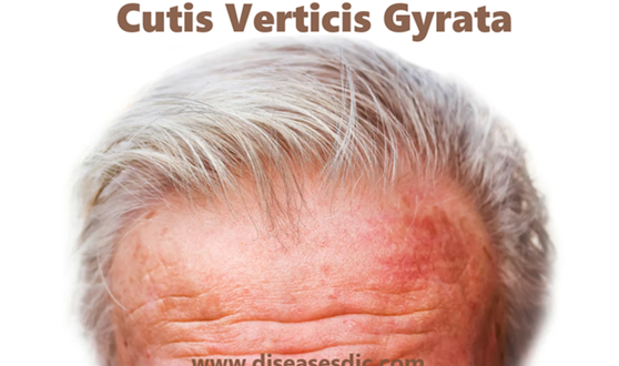 Cutis Verticis Gyrata (CVG) – Classification, Causes and Treatment