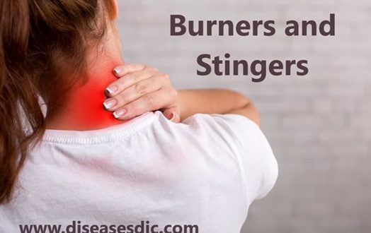 Burners and Stingers – Causes, Classifications and Treatment